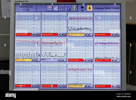 Trace Of Monitoring According To The Constants Of The Fetuses In The