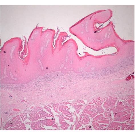 Photomicrograph Of Verrucous Hyperplasia Showing Blunt Surface