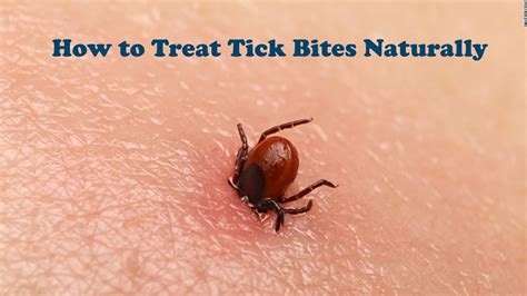 How To Treat Tick Bites Naturally How To Remove A Tick Bite And