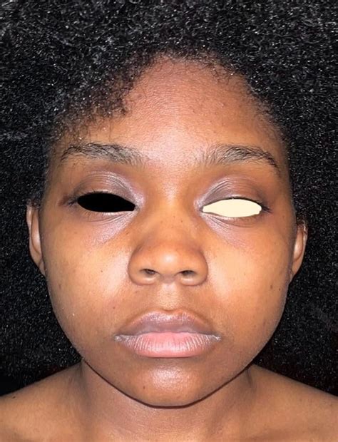 Dark Under Eyes And Hyperpigmentation Rblackskincare