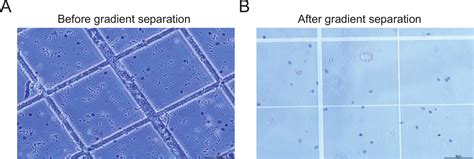 Nuclei Isolation From Fresh Frozen Brain Tumors For Single Nucleus Rna