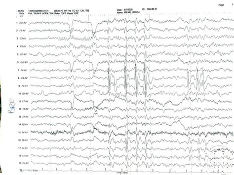 Abnormal EEG Patterns PPTX Brain And Nervous System Disorders Diseases And Conditions