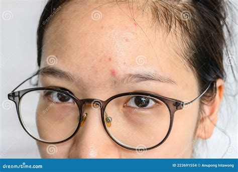 Close Up Of Woman Forehead With The Problem Of Acne And Scar From Acne