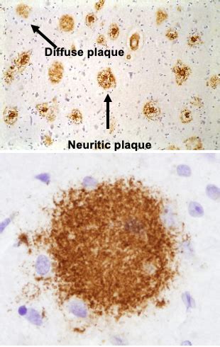 Neuropathology Flashcards Quizlet