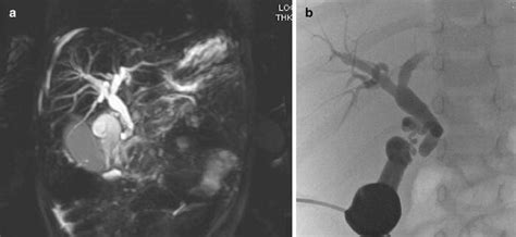 The Biliary Tree Radiology Key