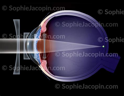 ŒIL MYOPE CORRECTIONS illustration medicale Sophie Jacopin