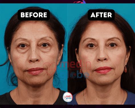 Eyelid Blepharoplasty Surgery Gallery