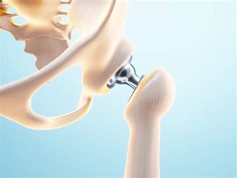 Metal Allergy After Joint Replacement Surgery Causes Symptoms And