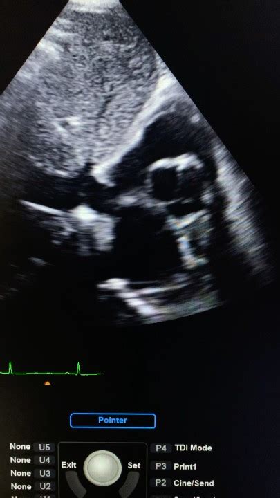 Eman Asaad On Linkedin When Parasternal Window Is Poor You Can Get A