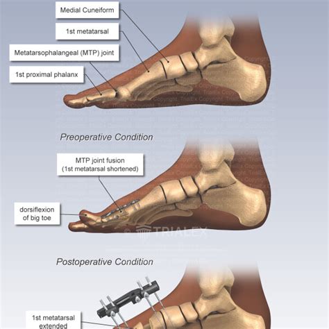 Metacarpophalangeal Joint Foot
