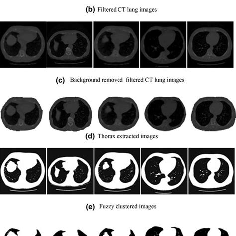 The Proposed Optimal Lung Nodules Detection Sequences Download