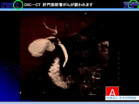 ガンちゃん先生奮闘記 たとえc型肝炎が治っても・・・肝門部胆管がん