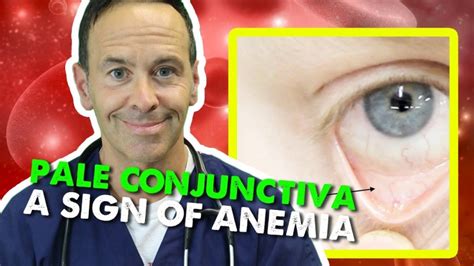 Dr Dave On Linkedin Anemia Conjunctiva Paleconjunctiva