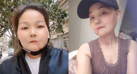 嚼檳榔10年！42歲網紅「右臉切除」仍癌逝 家屬證實：不再被病痛折磨 Enews新聞網
