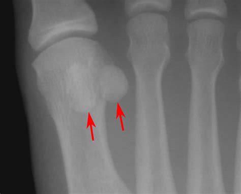 How To Treat Sesamoiditis Physioroom Blog