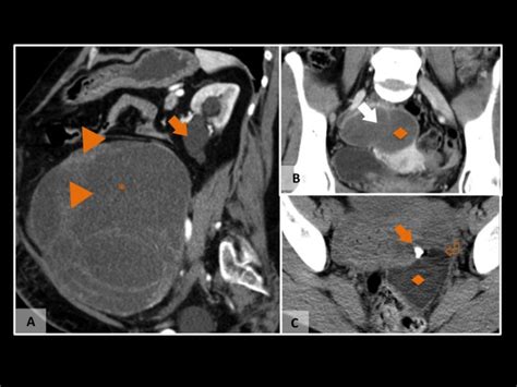 Sagittal A Enhanced Ct Scan Show A Large Mass In The Left Adnexal