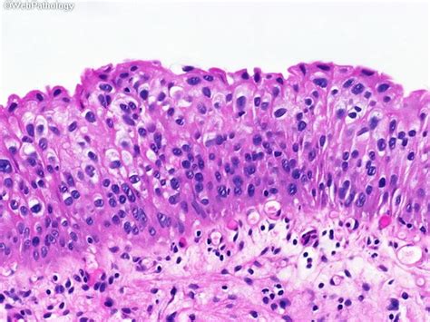 Urothelial Dysplasia
