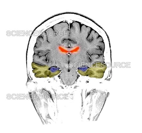 Temporal Lobes Stock Image Science Source Images
