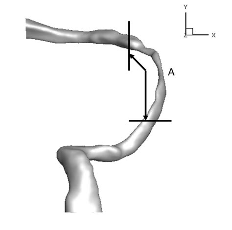 Venous Outflow Tract Model Of Symptomatic Side And The Study Area A Download Scientific Diagram