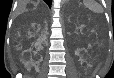 Cect Image Showing Bilateral Renomegaly With Large Cysts Within