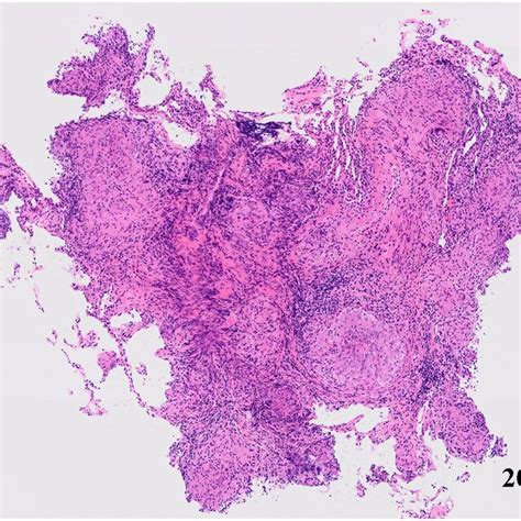 Hematoxylin Eosin He Stained Microscopic Image Of The Bronchoscopy