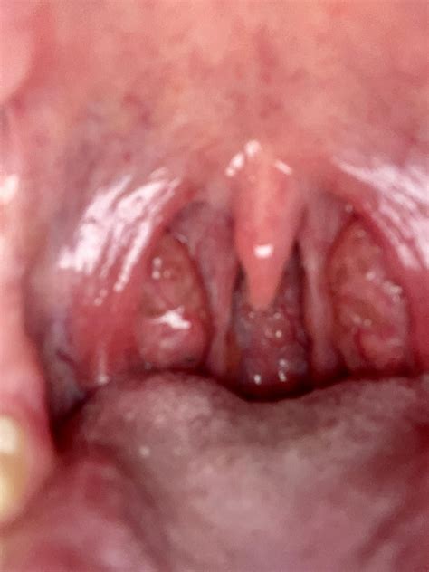 Is This Normal Mono Tonsils Rmononucleosis