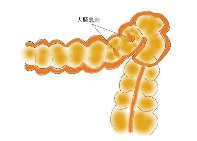 大肠息肉 肿瘤吗应该咋处理 澎湃号政务 澎湃新闻 The Paper