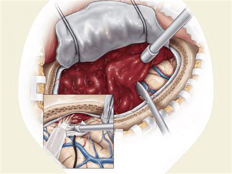 Middle Meningeal Artery Embolization Of Bilateral Subacute Subdural