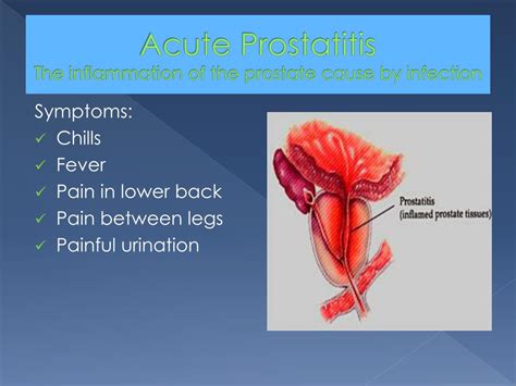 Ppt Prostate Health Understanding Awareness And Prevention