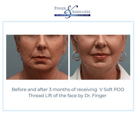 V Soft Lift Pdo Threads Finger And Associates Savannah Ga