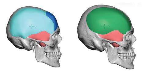 Evolution Of Head Widening Front Temporal Implant Designs Explore Plastic Surgery