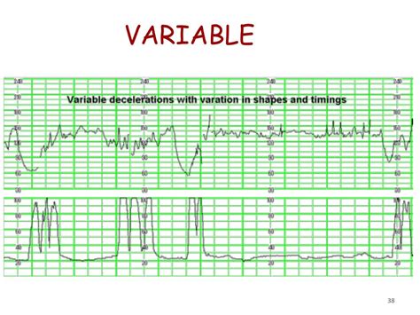 Ppt Electronic Fetal Monitoring Efm Cardiotocography Ctg Powerpoint Presentation Id