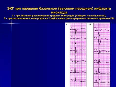 Зоны патологических изменений в сердечной мышце при инфаркте миокарда