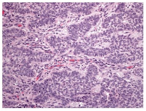 Micronodular Thymoma With Lymphoid Stroma Thoracic Key