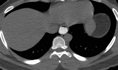 Ct Esophagography For Evaluation Of Esophageal Perforation Radiographics