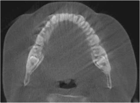 Cone Beam Computed Tomography Scan With Boney Sequestrum Of The Right Download Scientific