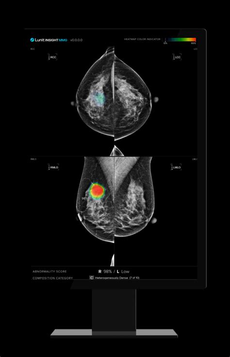 루닛 강북삼성병원에 Ai 유방암 검진 솔루션 공급 네이트 뉴스