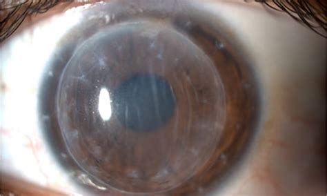 Corneal Graft Rejection Drug Market Review All Eyes On 2024 Outlook
