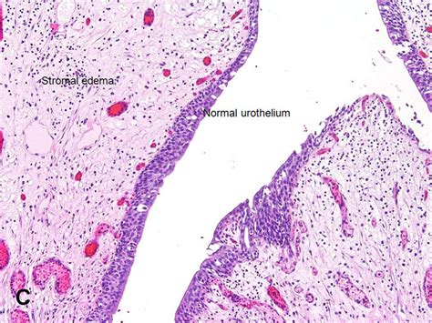 American Urological Association Polypoid Papillary Cystitis
