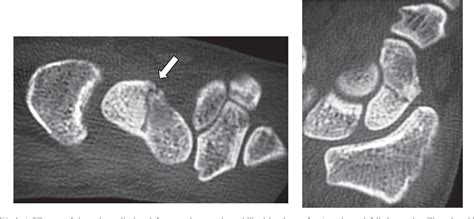 Figure 1 From Undisplaced Scaphoid Waist Fractures Is 4 Weeks