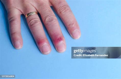 Chilblains Photos And Premium High Res Pictures Getty Images