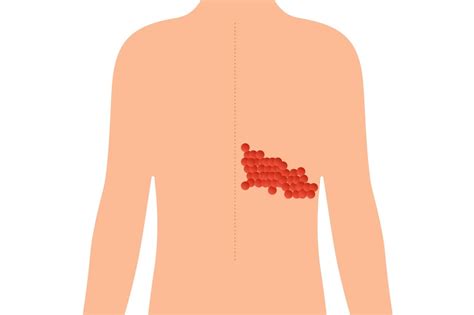 帯状疱疹ができやすい部位。症状を見分ける「2つのポイント」とは医師に聞く