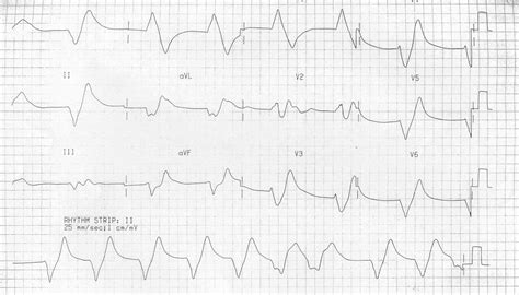 Severe Hyperkalaemia Sine Wave Appearance Emergency Medicine