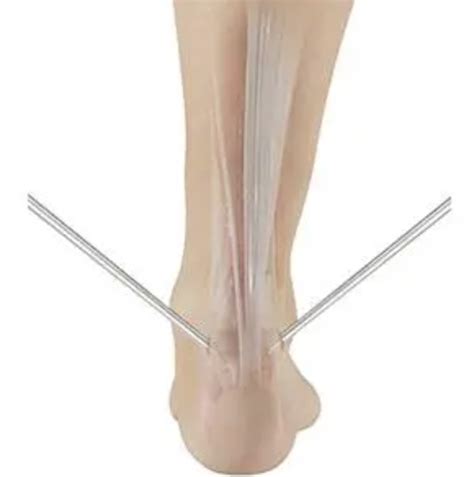 Arthroscopic Os Trigonum Excision Texas Orthopedic And Spine Associates