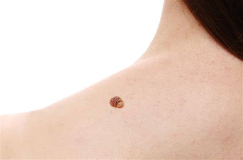 Verrugas en el cuello qué son por qué salen y cómo se pueden quitar