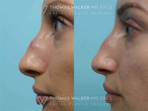 Mohs Reconstruction Before And After Photos Atlanta Ga