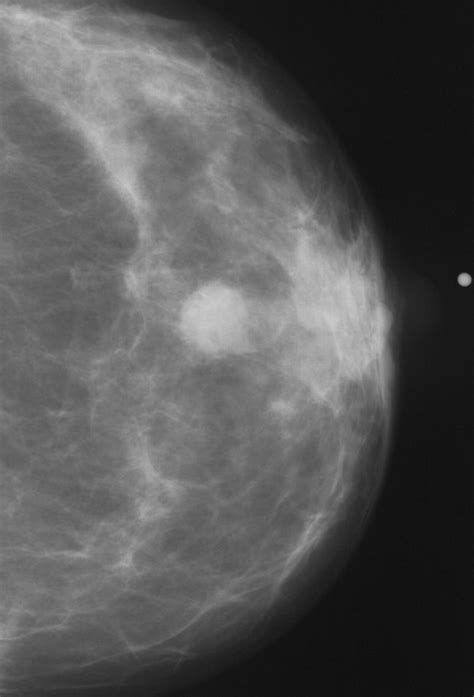 Women Skip Testing After Abnormal Mammogram If They Have High