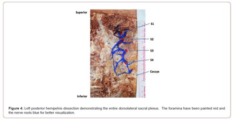 Dorsolateral Sacral Plexus An Anatomical Description Iris Publishers