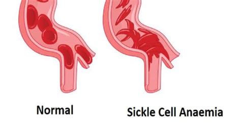 Steps That Can Be Taken To Eliminate Sickle Cell Anaemia From India