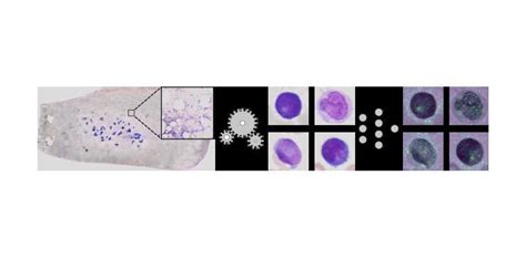 New Ai Based Method Supports Acute Myeloid Leukemia Diagnosis